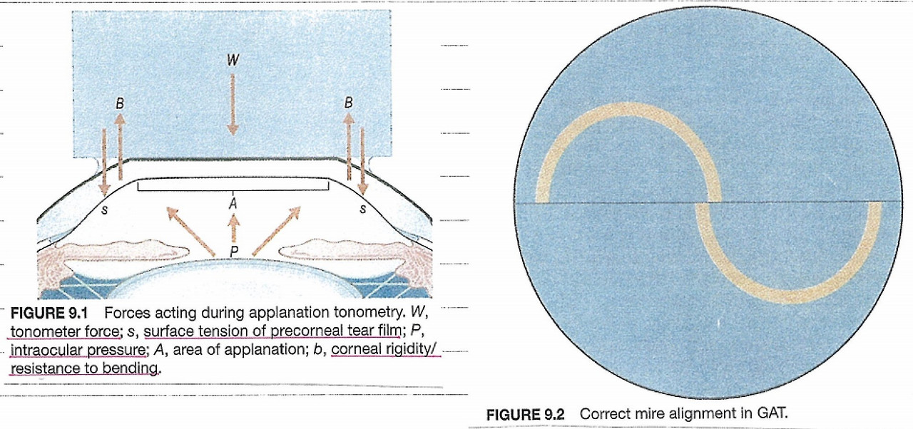 골드만 압평 안압계 Goldmann applanation tonometer, GAT