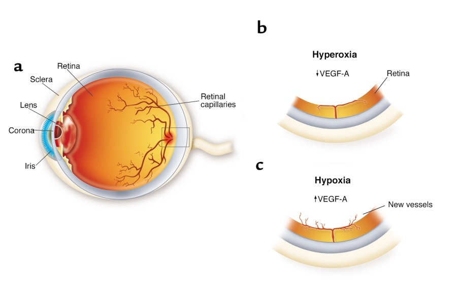 신생혈관 녹내장, Neovascular glaucoma, NVG 뜻, 의미, 원인 질환, 기전, 발생이유