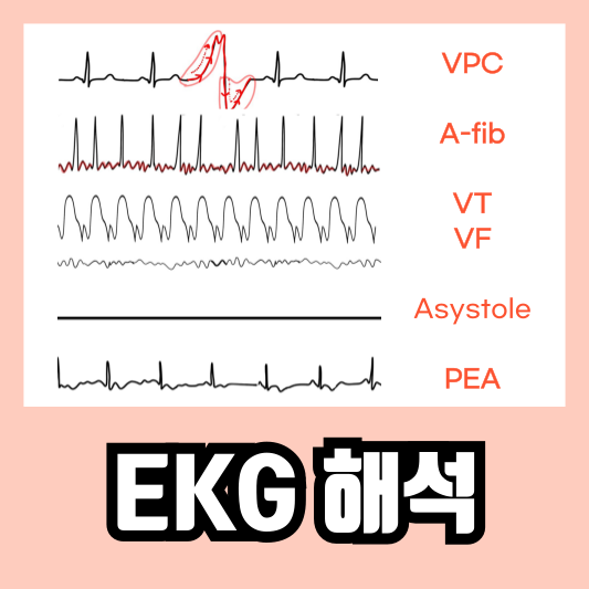 정상 EKG APC VPC Afib V-tec V-fib Asystole PEA 해석