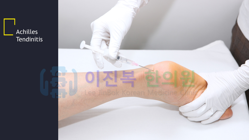 전주 이진복한의원 아킬레스 건염