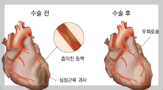 심부전증 수술 치료방법 인공심장 심장판막 관상동맥우회술 스텐트삽입술