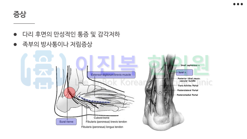 전주 이진복한의원 비복신경 포착증후군