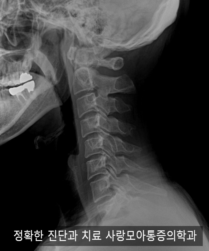 대구 목 치료 목 Mri 프롤로 주사 대구 사랑모아통증의학과