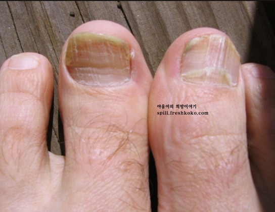 발톱무좀 없애는 방법 17가지