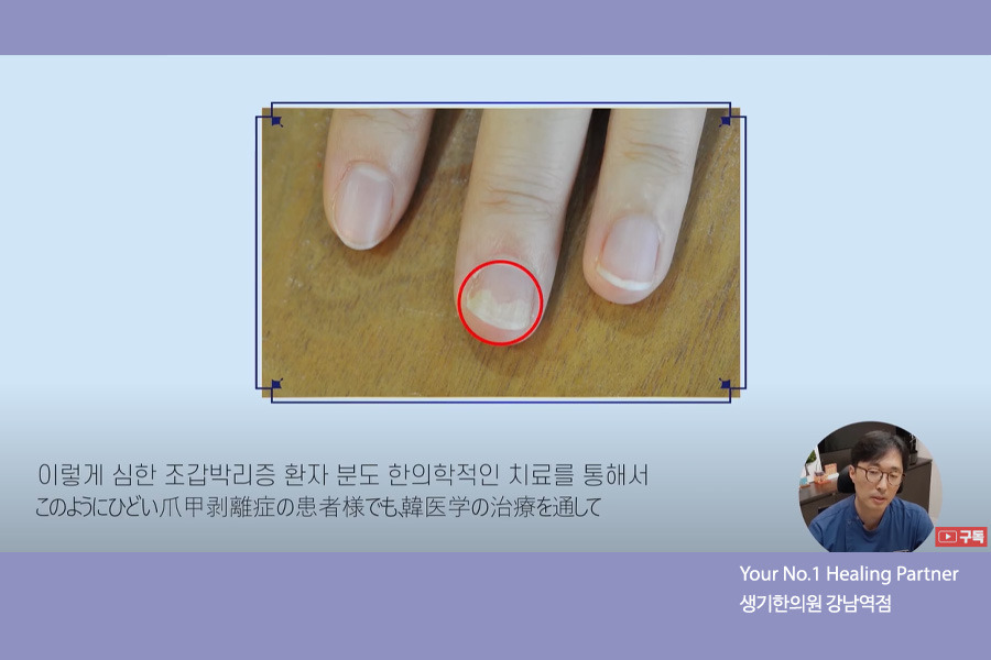 강남조갑박리증에 증상 자세히 알아봐요 생기한의원 강남역점 박치영한의사