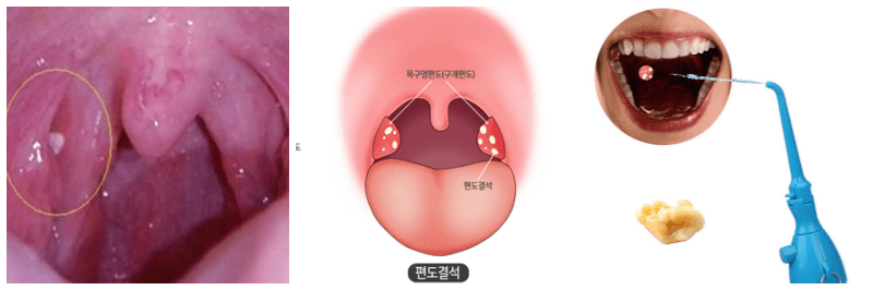 편도결석 제거기로 편도결석 빼는법과 원인 증상 제거 예방법