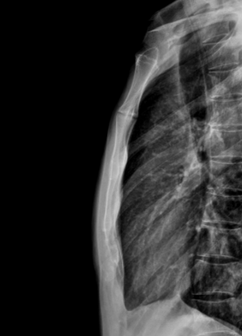 일반촬영 x-ray 엑스레이 복장뼈, 흉골 (sternum series) - sternum lateral 촬영방법