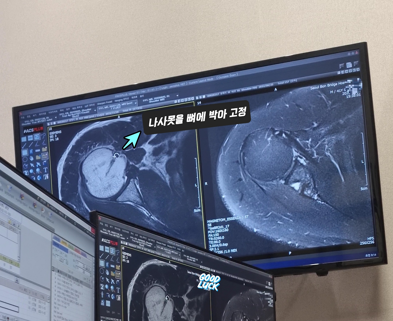 어깨수술 후 Mri 검사 결과 보기 모두의 생활정보