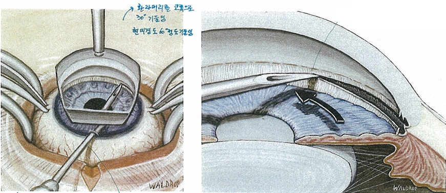 선천 녹내장 수술, 전방각절개술, Goniotomy 시술과정, 방법, 성공률, 치료법