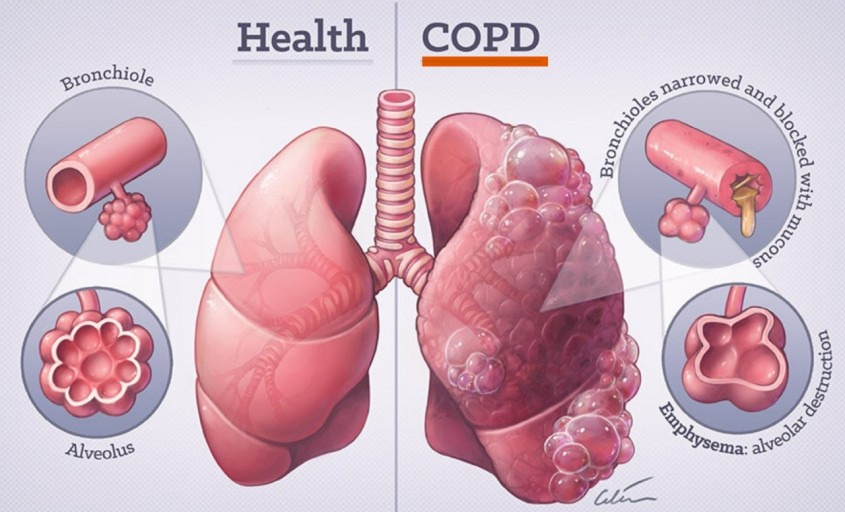 만성 폐쇄성 폐질환(COPD) 원인, 증상, 치료방법 알아보기