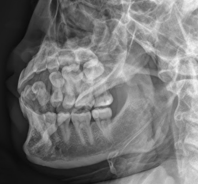 Mandible PA·PA axial,AP Axiolateral OBL/TM Joint Axiolateral