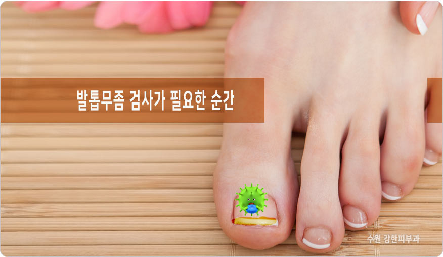 발톱무좀 없애는 방법 최신