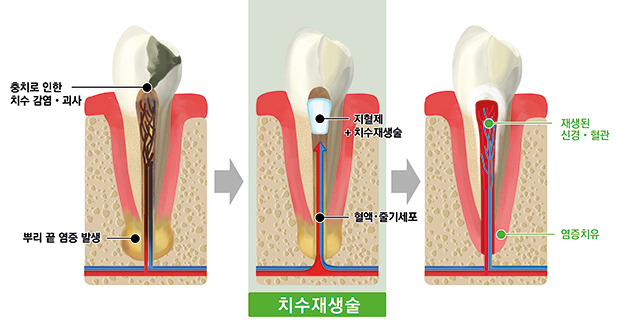 치과 신경치료란 정확히 알아보는 신경치료 과정과 필요성