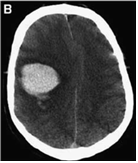 뇌출혈 부위에 따른 CT 양상(EDH, SDH, SAH, ICH, IVH)