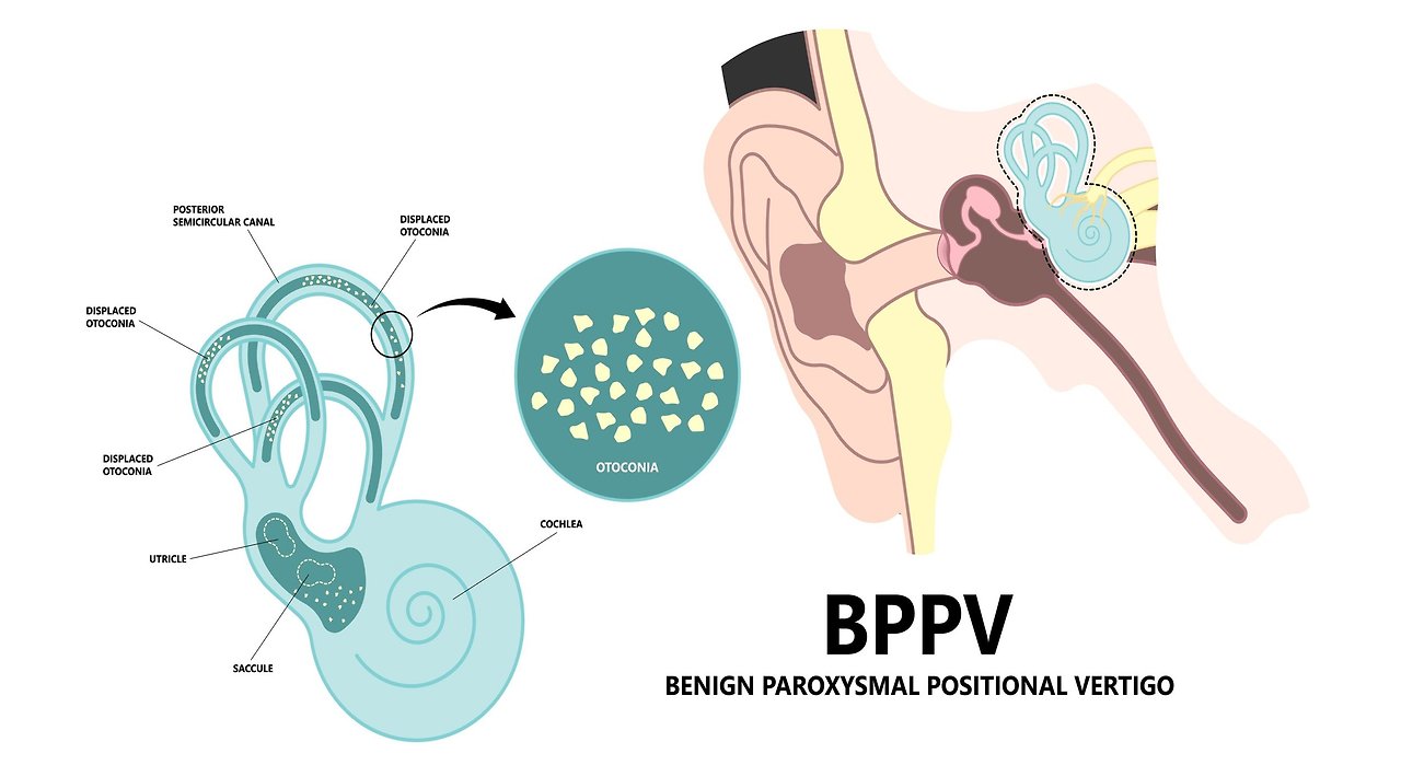 이석증 증상 원인 진단 치료 총정리