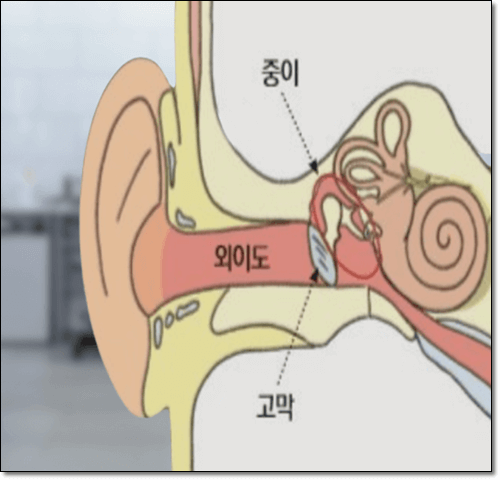 한쪽 귀 먹먹 원인 및 증상과 이관 개방증