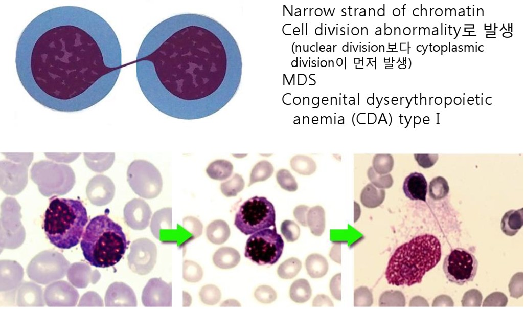 골수 검사(4) - Dysplasia 란?