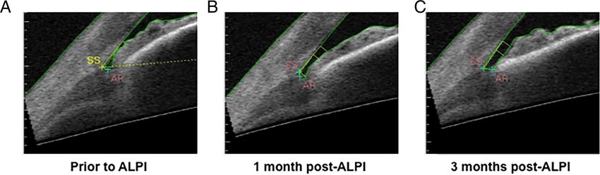 아르곤 레이저 주변홍채 성형술(Argon Laser Peripheral iridoplasty, ALPI, LPI, Argon ...
