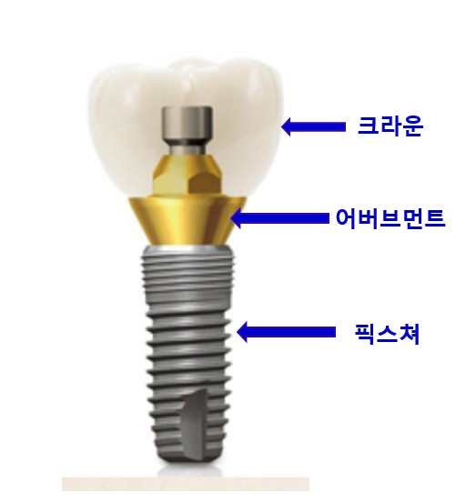 임플란트 가격 종류 시술과정 가격비교 사이트 총정리