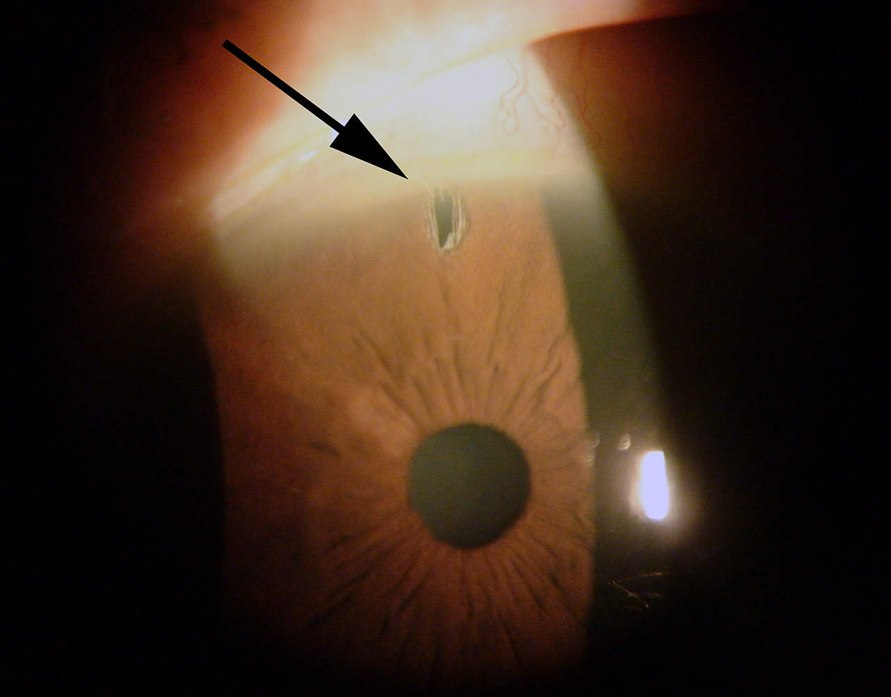 녹내장레이저수술 - 레이저홍채절개술 Laser Iridotomy, Argon LI & Nd:YAG LI