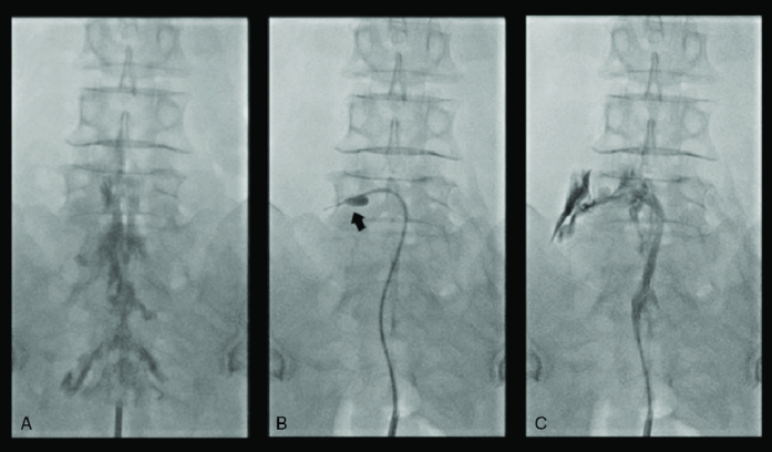 신경성형술(Neuroplasty). 그게 뭔가요?