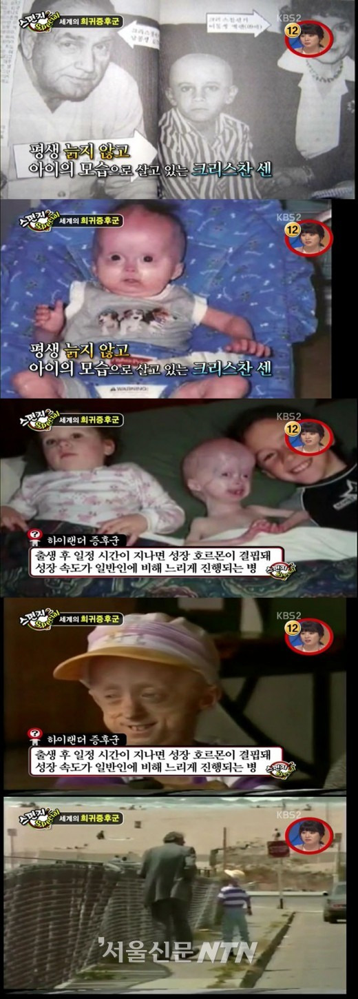 스펀지 늙지 않는 하이랜더 증후군 실제 벤자민 버튼 소개