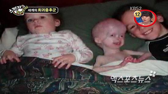 하이랜더 증후군 평생 늙지 않아 실제로 가능