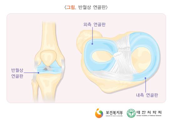 과격한 운동 즐긴다면 주의 반월상 연골 파열