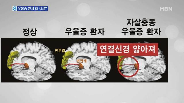 우울증 환자 뇌 속 3가지 변화가 자살 불러와