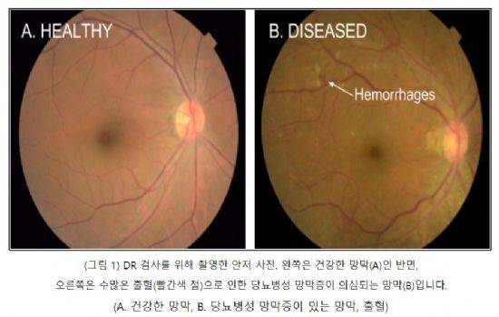 당뇨병성 망막증 진단ai 의사 수준 됐다