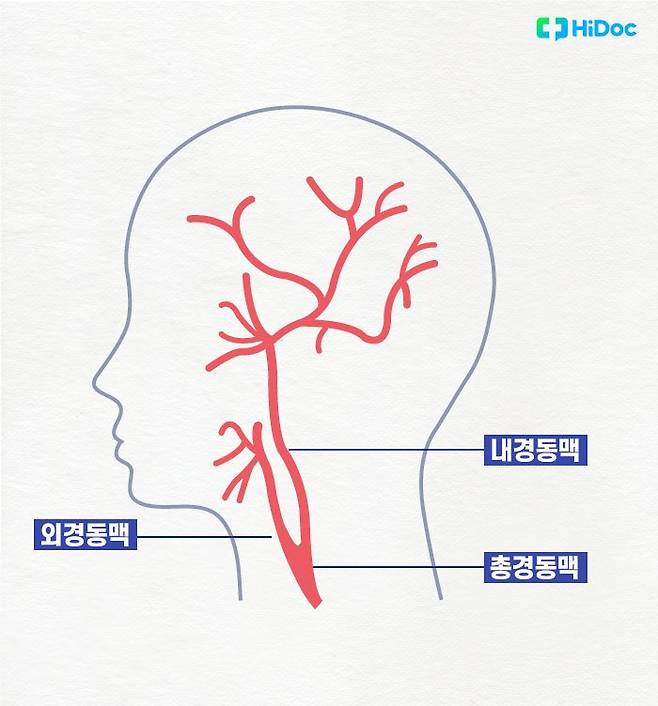동맥이 절반 가까이 막혀도 모른다 경동맥 협착증
