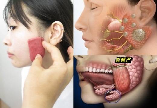 침샘비대증 귀밑몽우리는 턱관절치료가 먼저