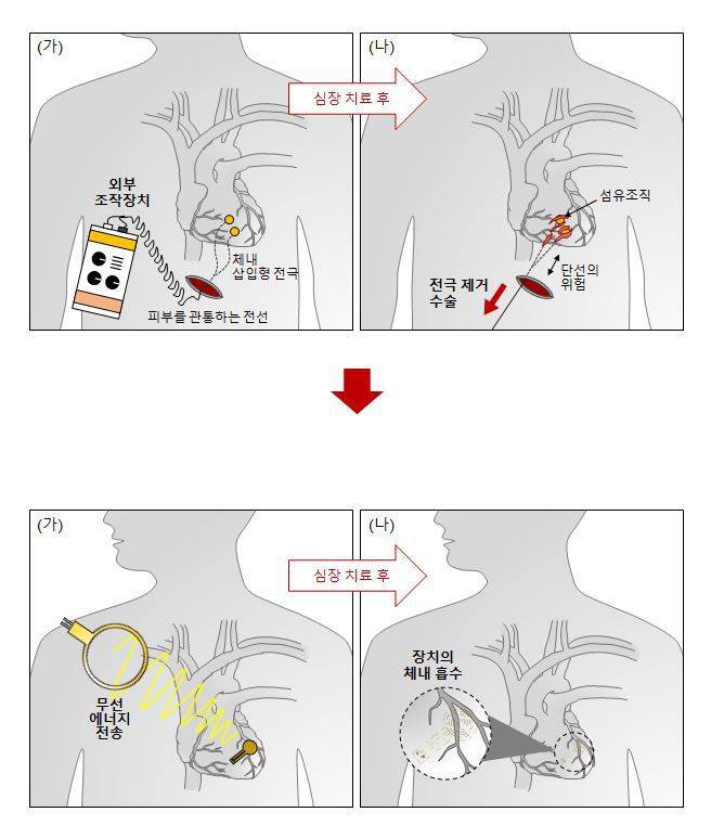 몸속에서 녹아 사라지는 심장박동조율기 在美 한인 과학자 개발