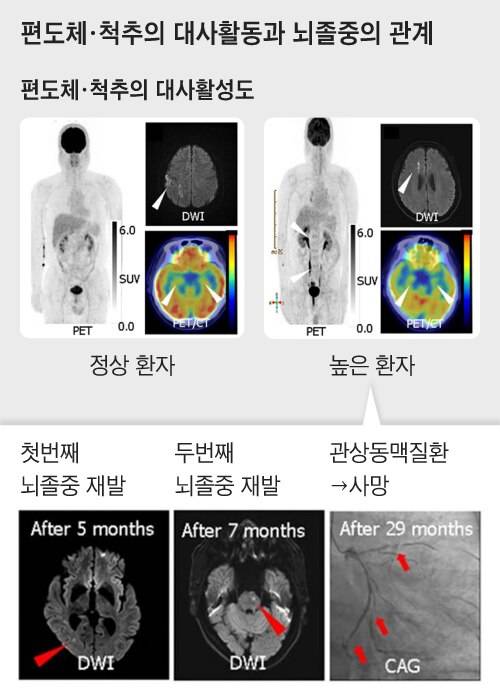 혈관 관리 잘했는데 심근경색 앓는 뇌졸중 환자 원인 찾았다