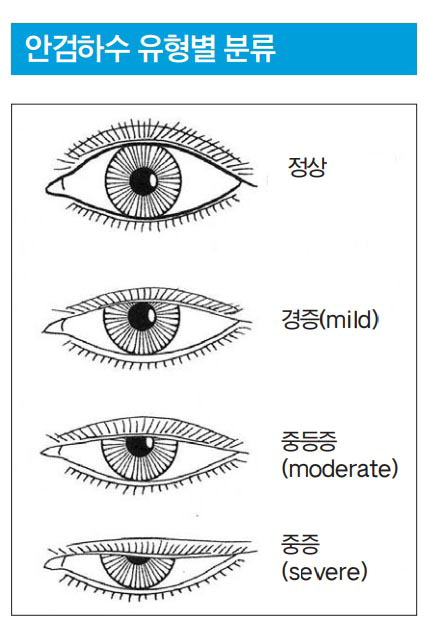 처진 눈꺼풀 수술 공통근막 이용 땐 합병증 적고 효과 커