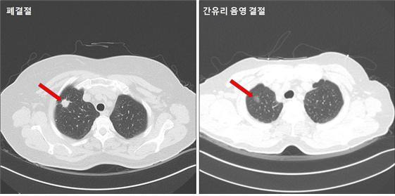 저선량 Ct 검사에서 ‘간유리 음영이라는데