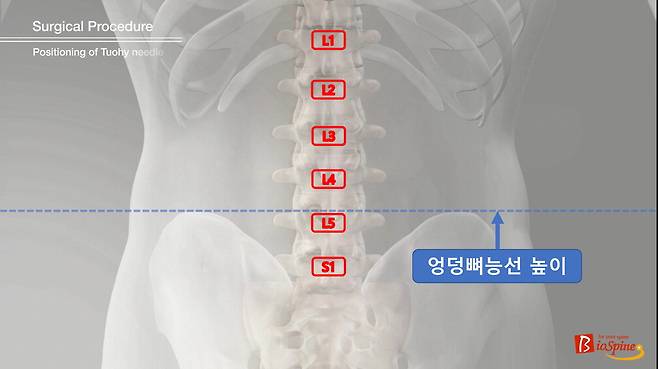 서울 광혜병원 난도 높은 L5~s1 척추관협착증 추간공확장술로 치료하려면