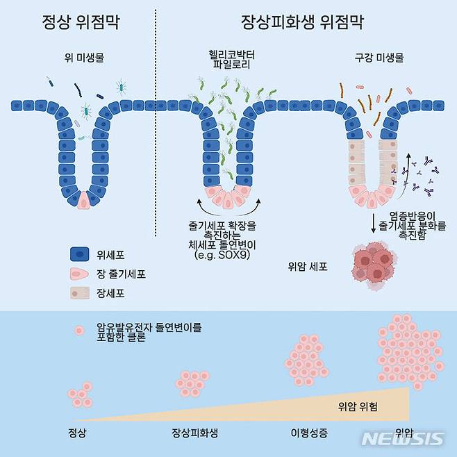 위암 발병위험 6배 높이는 이것유전자변이 규명했다