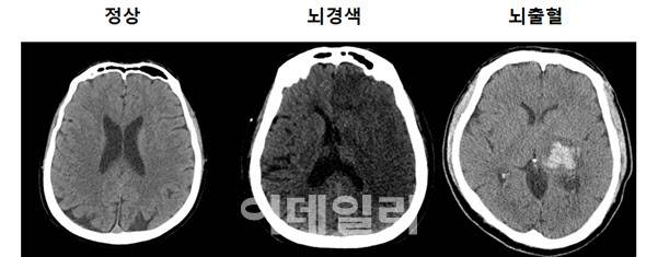 뇌 Ct·mri 무슨 차이일까 뇌졸중 극복하기