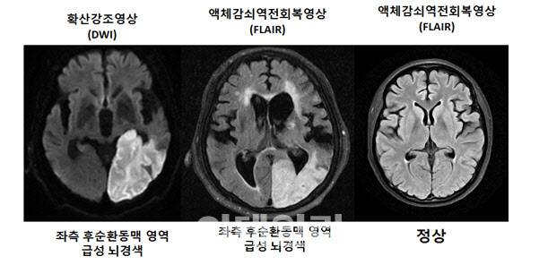뇌 Ct·mri 무슨 차이일까 뇌졸중 극복하기