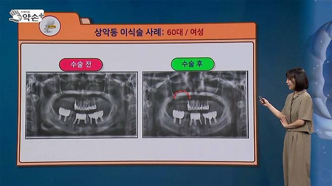 약손 뿌리부터 튼튼 제3의 치아 임플란트 ⑨뼈 이식 사례