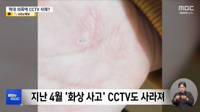문 닫다가 유치원서 손가락 잘린 4살‥교사 아동학대 혐의 송치