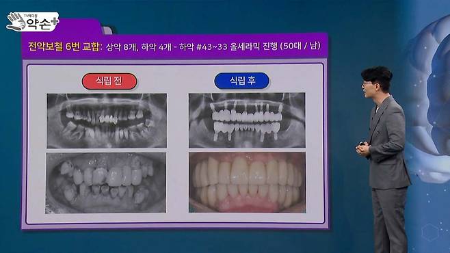 약손 다수의 치아상실 재건 전악보철 ⑬임플란트와 보철 재료별 차이