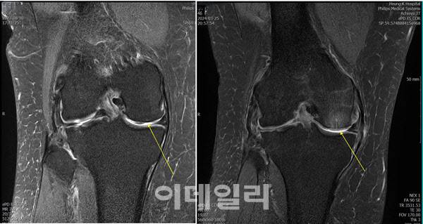 바이오솔루션 카티라이프 연골 재생력 치료제 중 가장 좋아