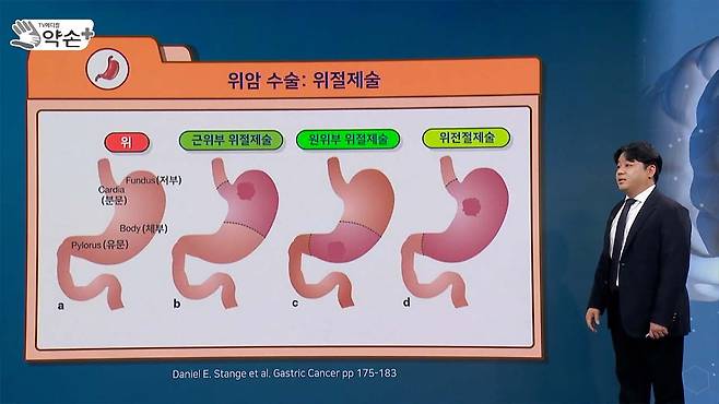 약손 앎으로 암을 극복 위암 수술 후 건강관리 ⑨위암 수술 범위