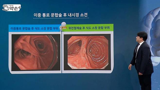약손 앎으로 암을 극복 위암 수술 후 건강관리 ⑪위장과 소장