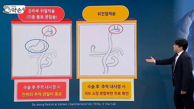 약손 앎으로 암을 극복 위암 수술 후 건강관리 ⑪위장과 소장