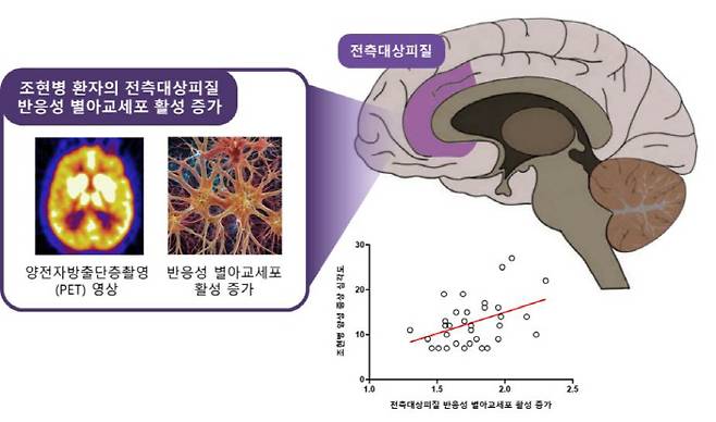 조현병 환자 뇌 반응성 별아교세포 활성 증가 최초 확인치료제 개발 기여