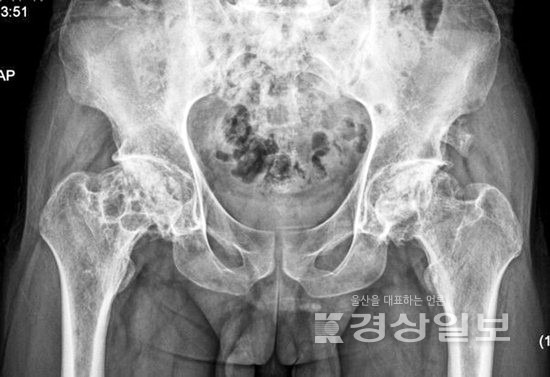 대퇴골두 무혈성괴사 양반다리 힘들거나 고관절 아프면 의심 경상일보