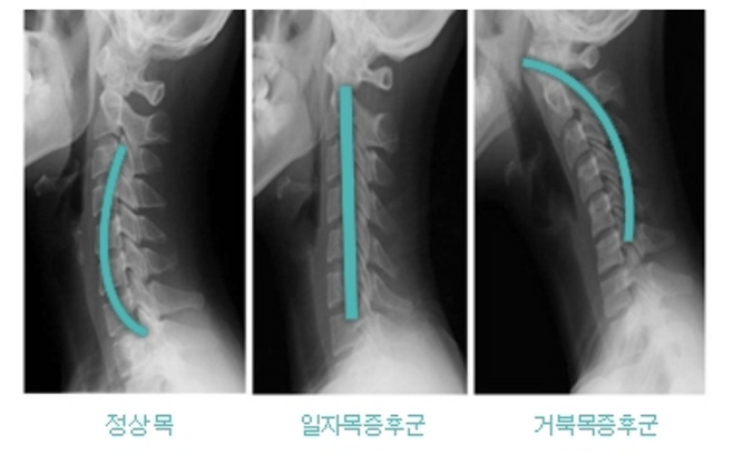 유퀴즈에 나온 척추의 신 정선근 교수가 알려주는 목 스트레칭 제대로 하는 방법 피티원